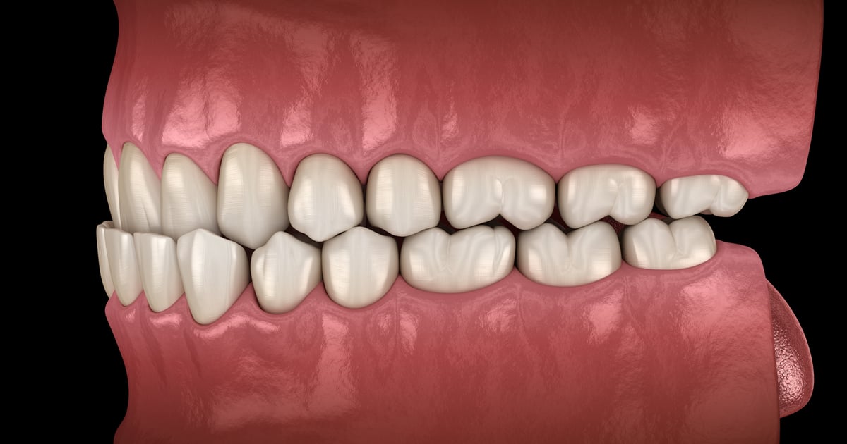 Malocclusione - Trattamenti | Studio Dentistico Dr. Tommaso Martella